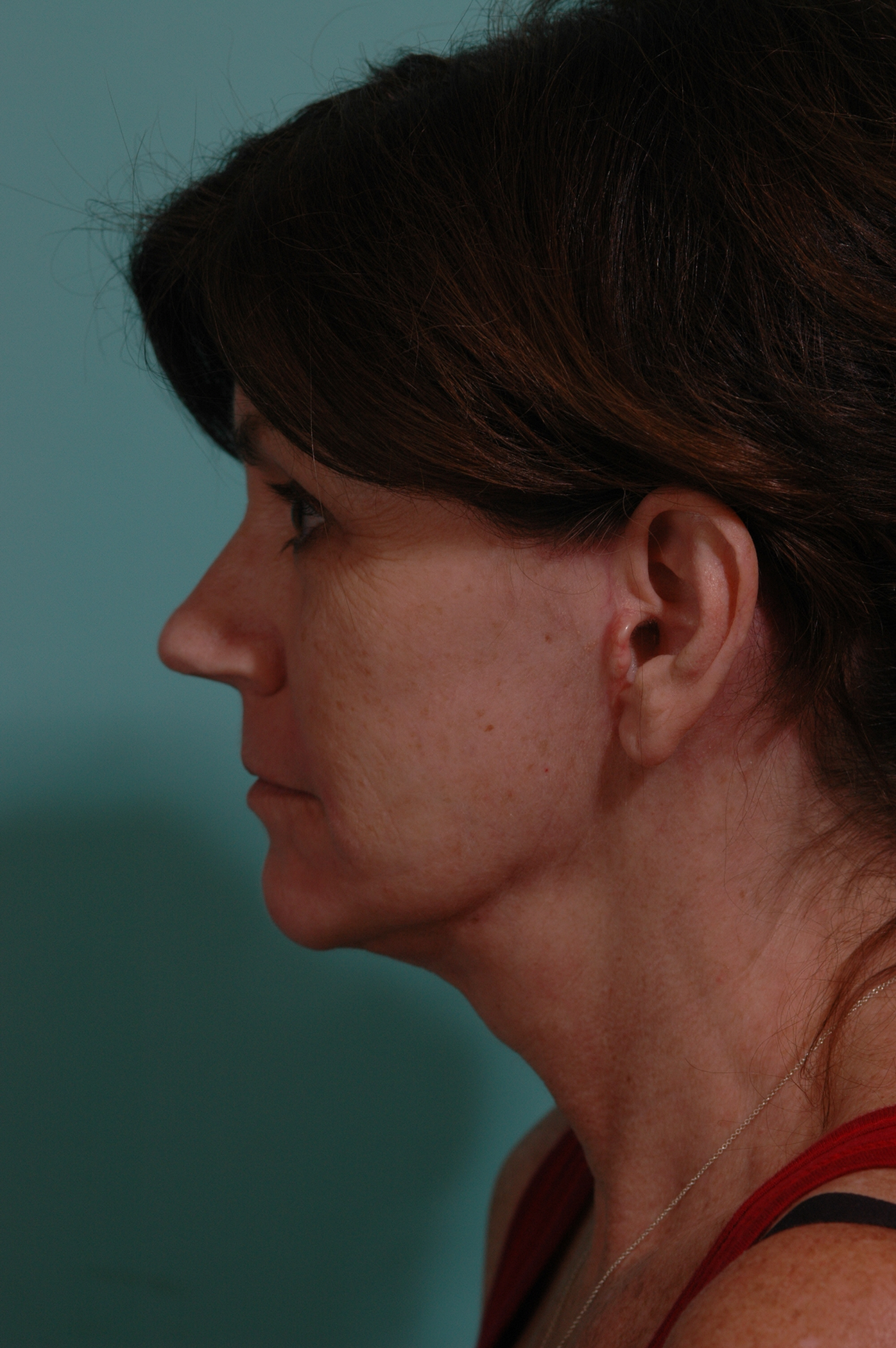 Beverly Hills Facelift Procedure - Rhytidectomy Plastic Surgery