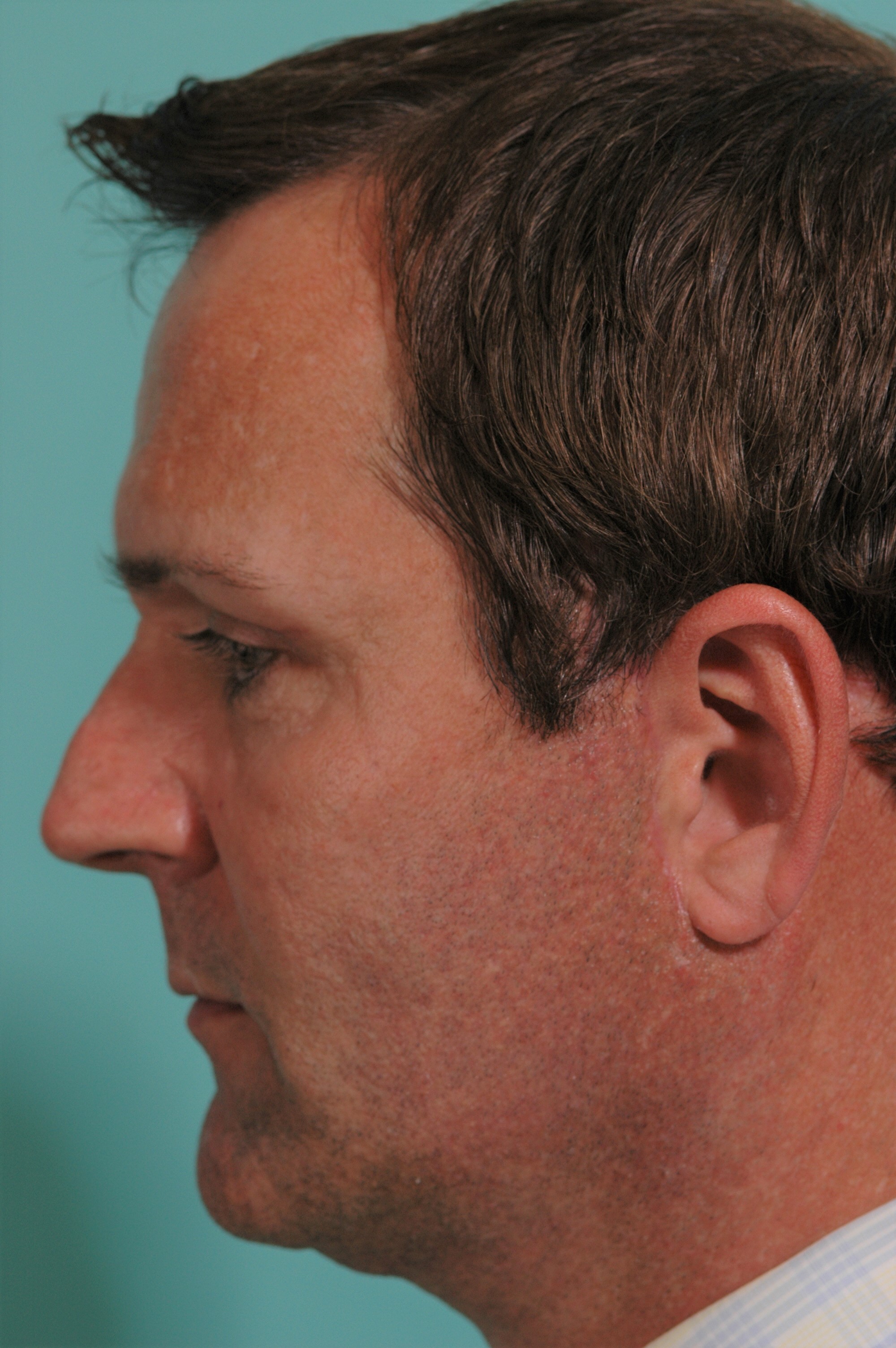 Beverly Hills Facelift Procedure - Rhytidectomy Plastic Surgery