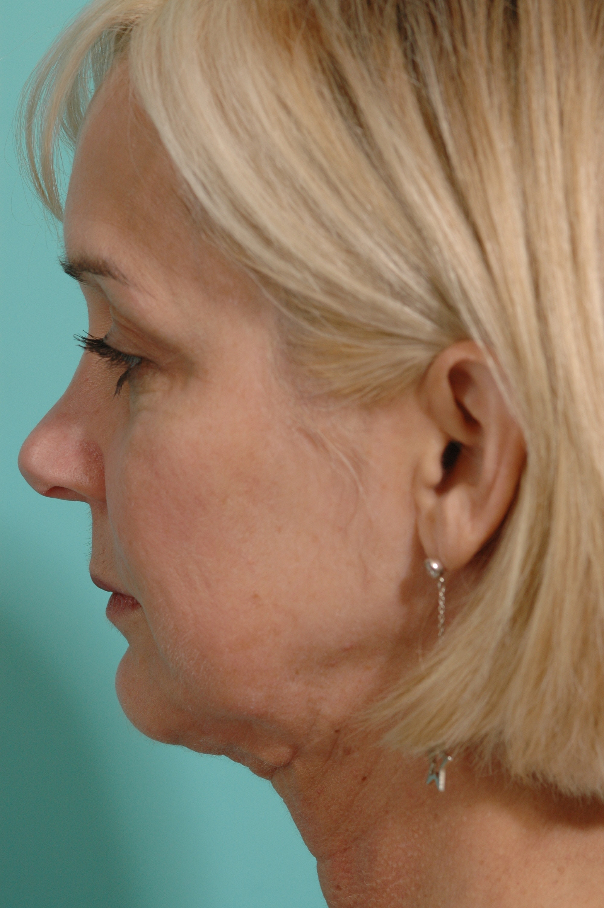 Beverly HIlls Neck Lift Procedure - Platysmaplasty Procedure