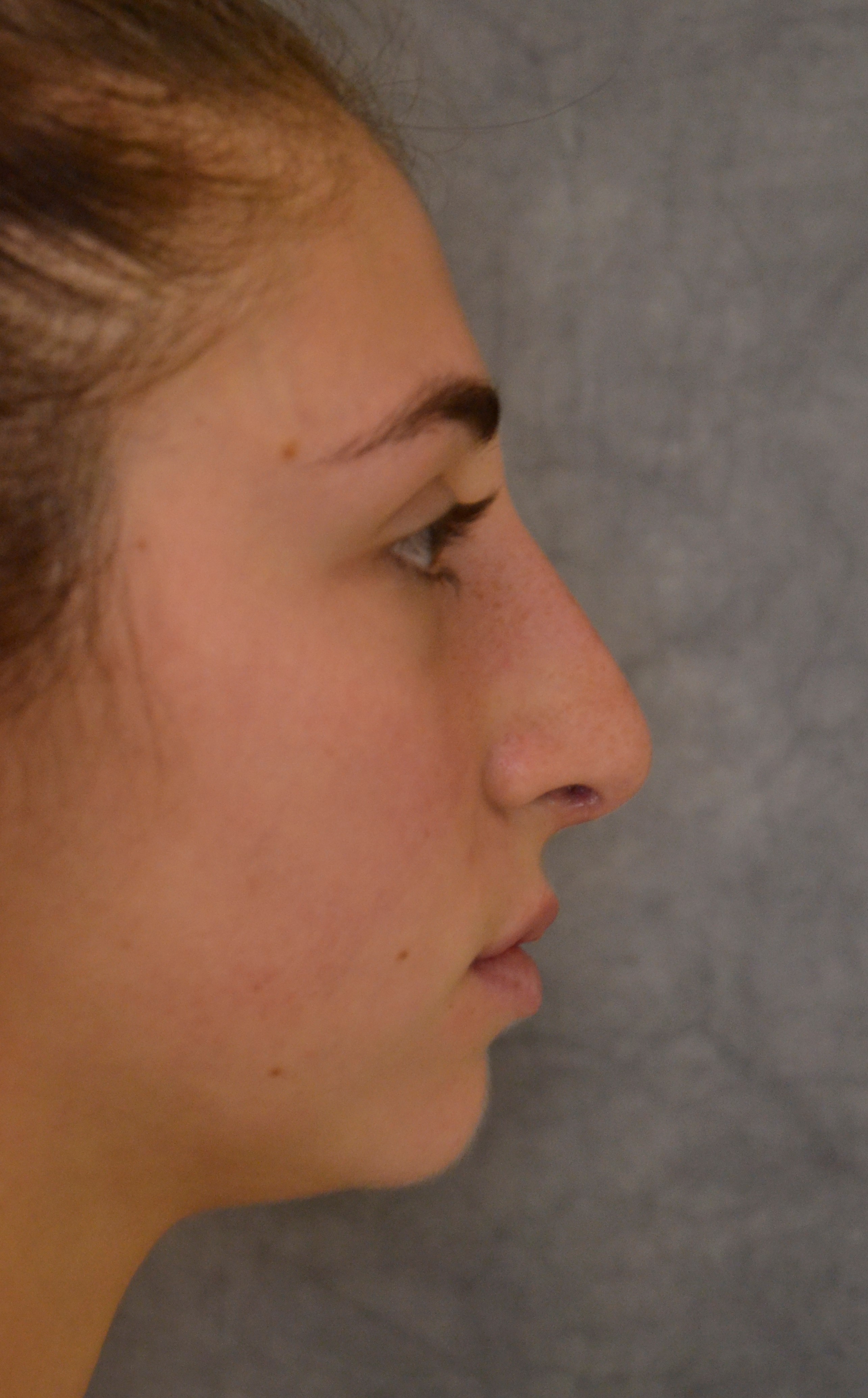 Rhinoplasty in Los Angeles - Nose Job Doctor