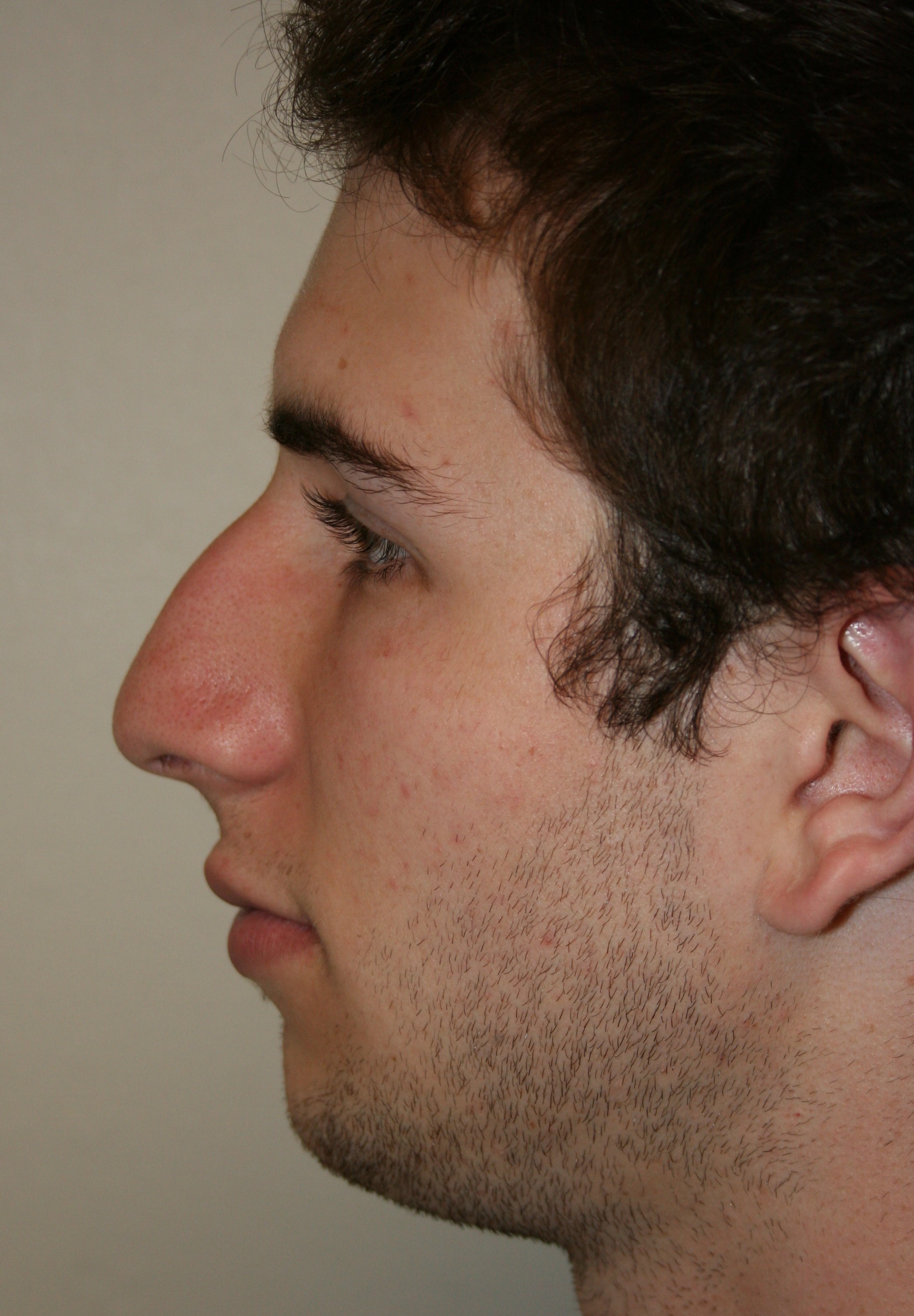 Rhinoplasty in Los Angeles - Nose Job Doctor