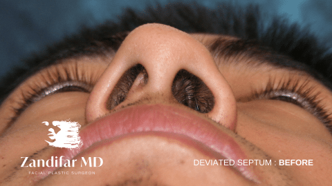What are the signs You May Have A Deviated Septum - Zandifar MD