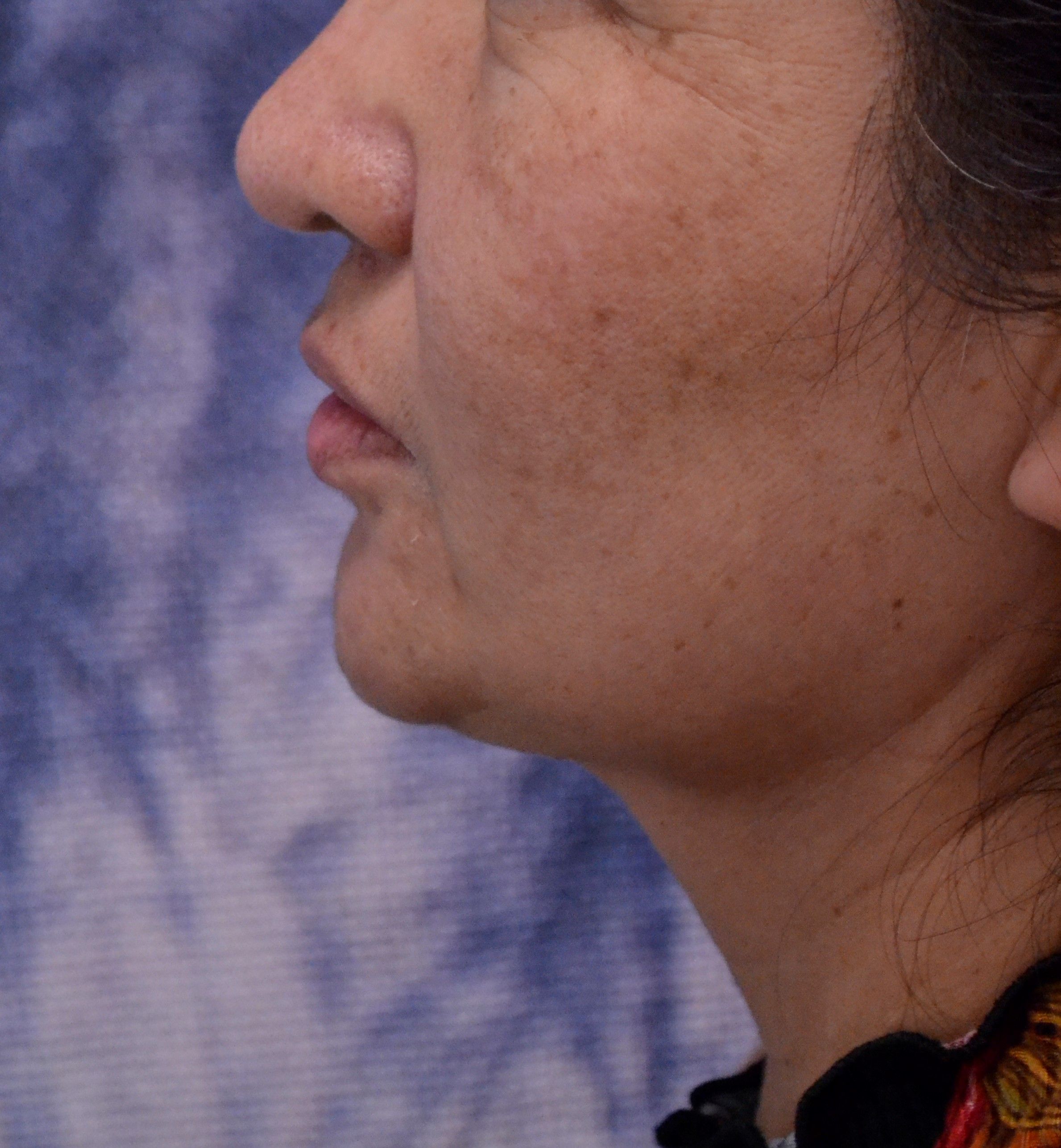 Facial Lipo Contouring - Face Jaw & Neck Fat Removal - Los Angeles