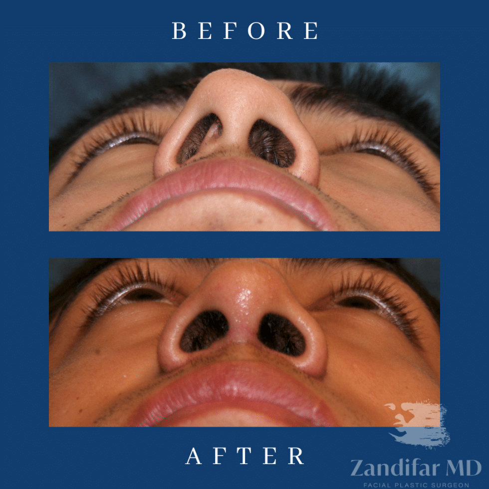 Category: Deviated septum