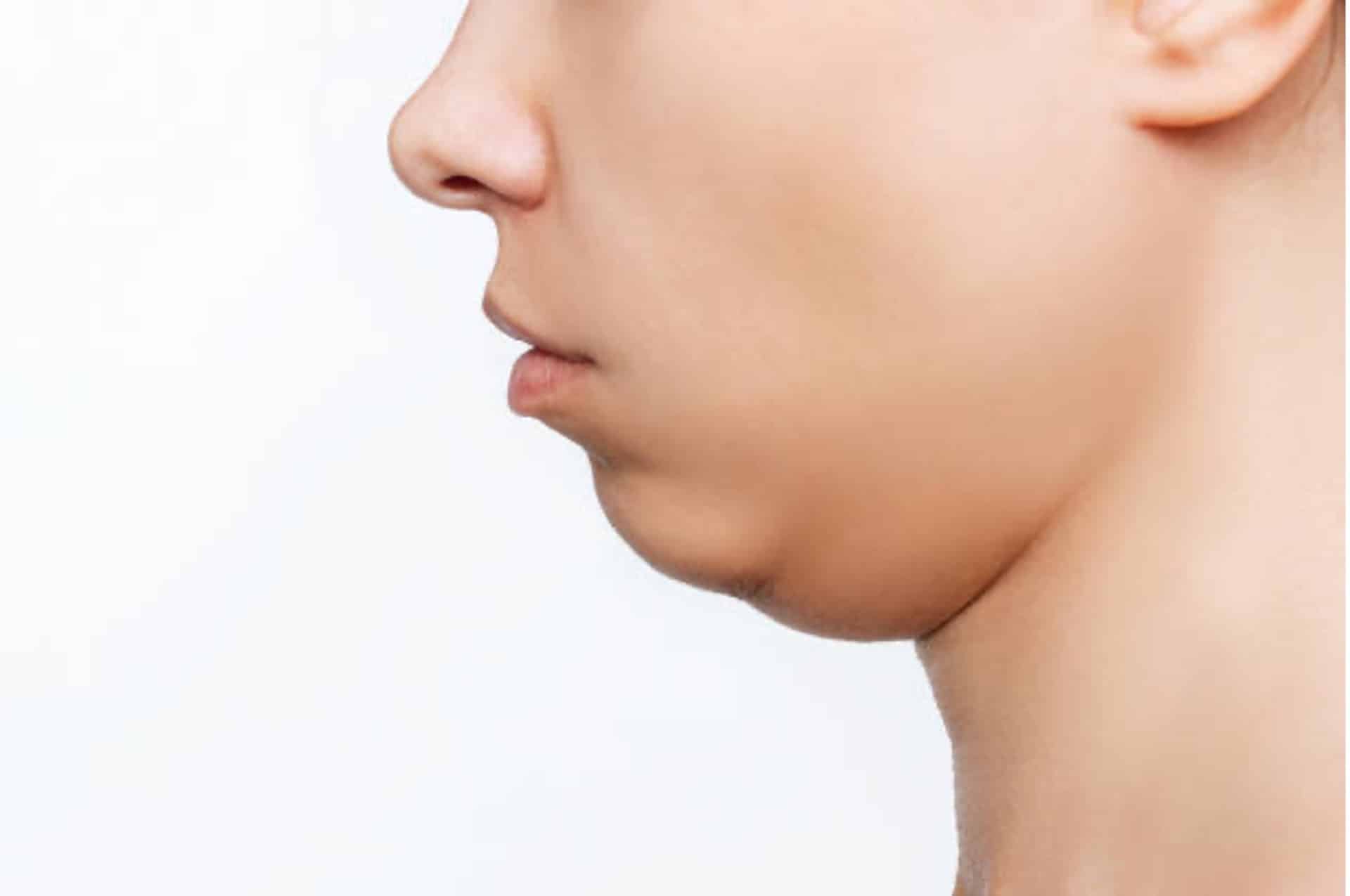 Breaking Free from the Double Chin: Options for Submental Fat Reduction