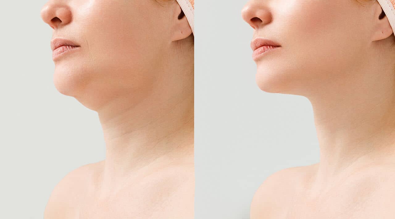 How to Maintain a Youthful Neck Without Surgery